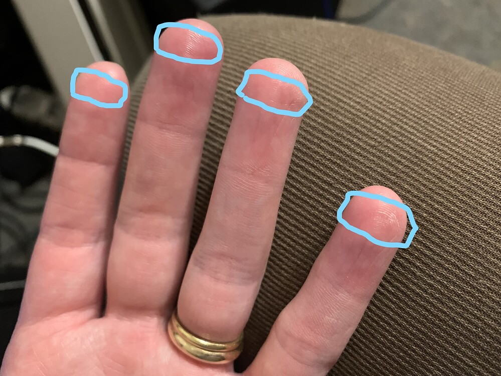 New bass calluses! Are they in the right place? - Technique - BassBuzz ...