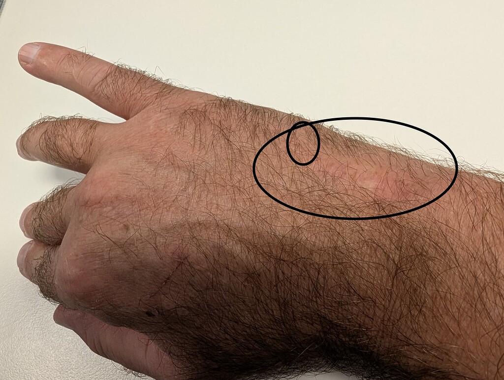 Pinky tendon severed! - Technique - BassBuzz Forum